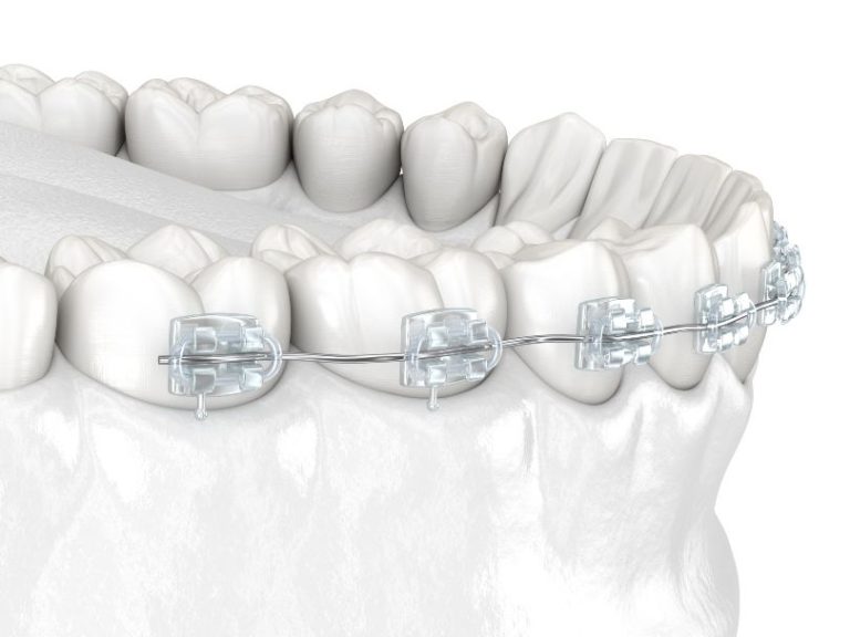Dental Braces in Turkey: Cost, Procedure and Treatment