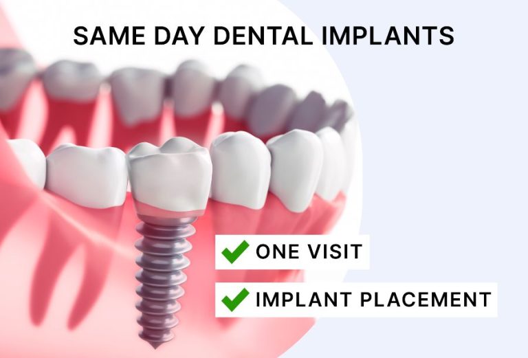 Same Day Dental Implants in Turkey - Parmire